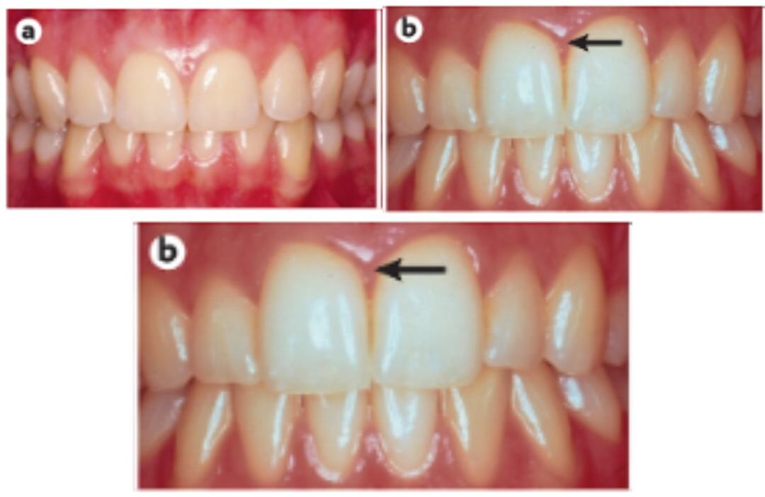 Probiotics Applications in Periodontitis Treatment - FUTURE BIOMED ...