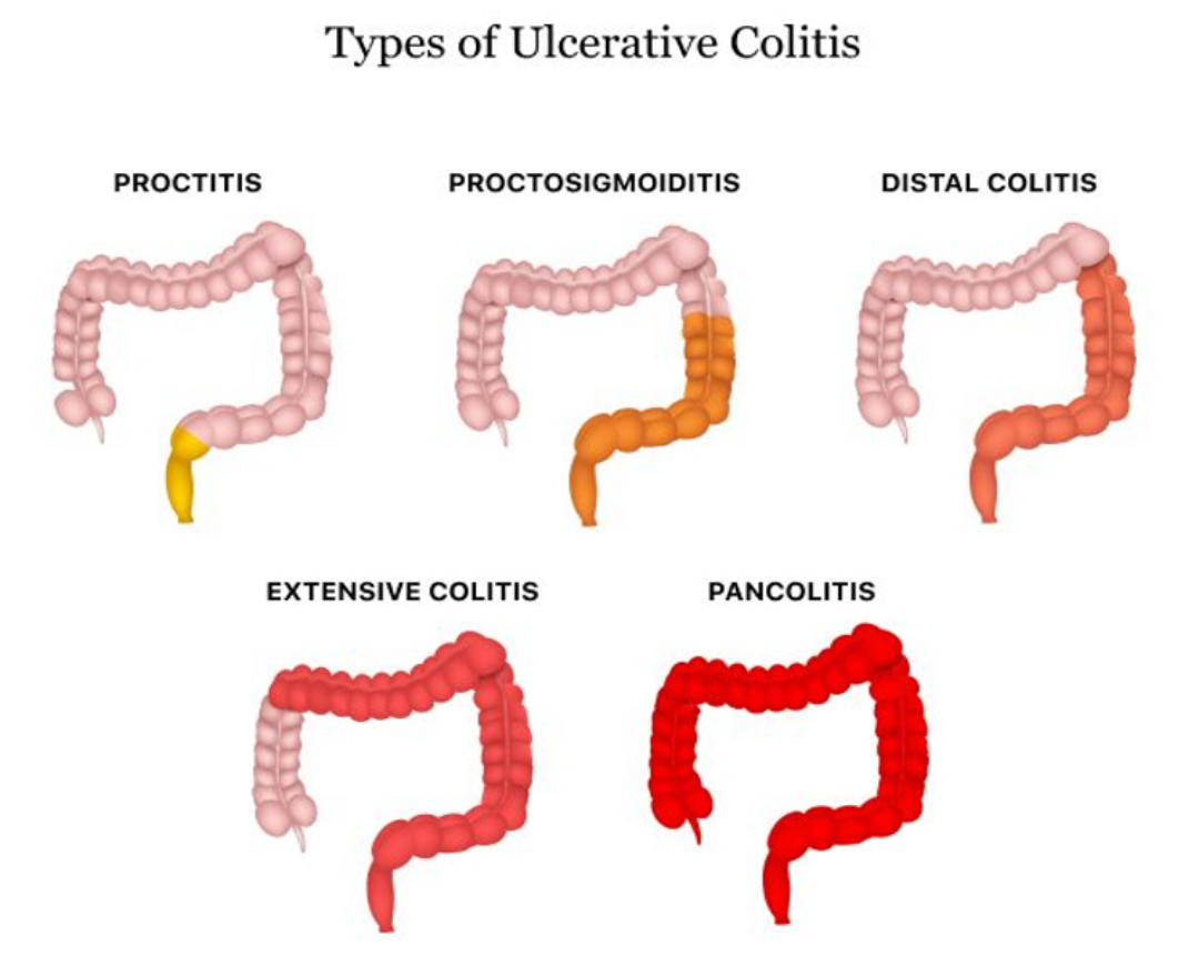Application of probiotics in the prevention and management of ...